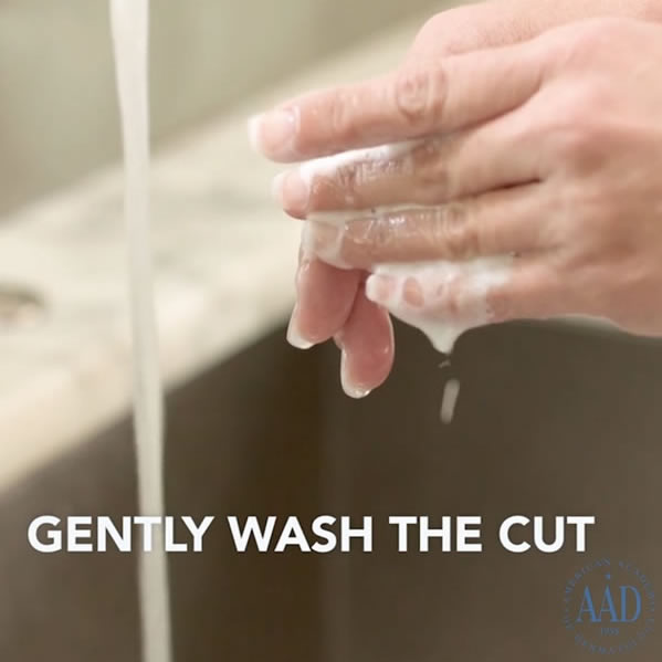 How to Treat a Minor Cut - Metrokids